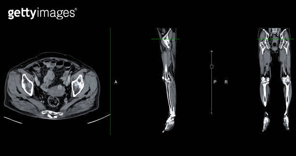 A CT venogram of the leg is a non-invasive imaging procedure offering ...
