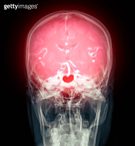 Fusion image combining skull X-ray and CT brain scan, offering a ...