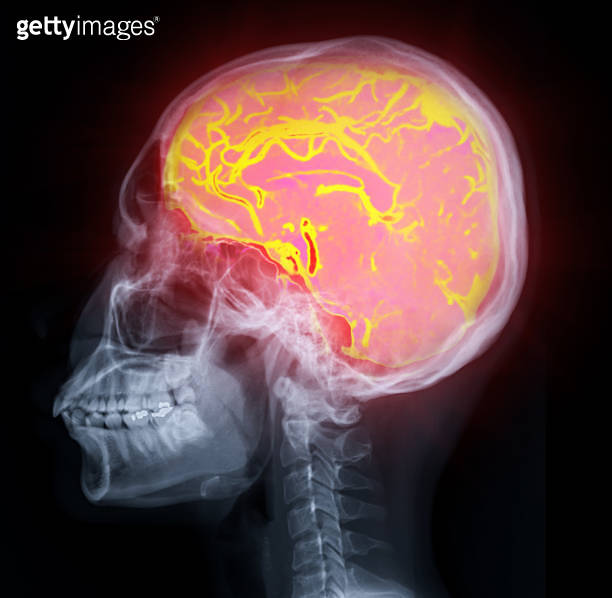 Fusion image combining skull X-ray and CT brain scan, offering a ...