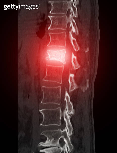 Lumbar Spine CT Imaging with L1 Compression Fracture A vivid CT scan ...
