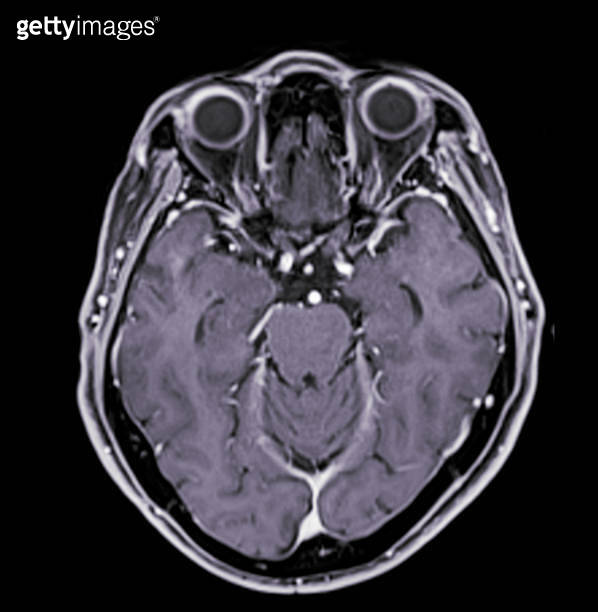A normal contrast-enhanced MRI scan of the brain showing clear ...