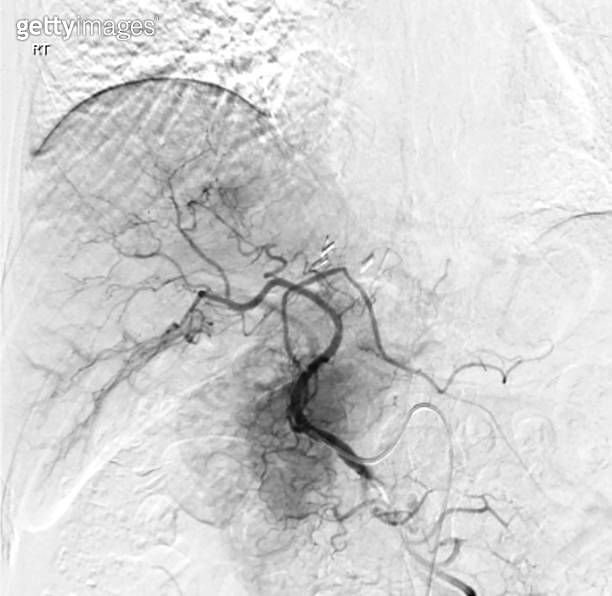 A TACE procedure image showing selective catheterization of the hepatic ...