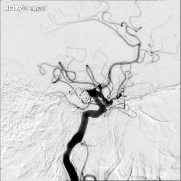 Endovascular coiling during a cerebral angiogram shows the precision ...