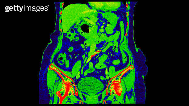 CT scan of Abdomen coronal view with injection contrast media with ...
