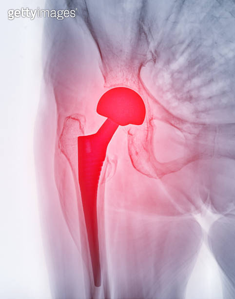 An X-ray reveals both hip joints with TOTAL HIP ARTHROPLASTY ...