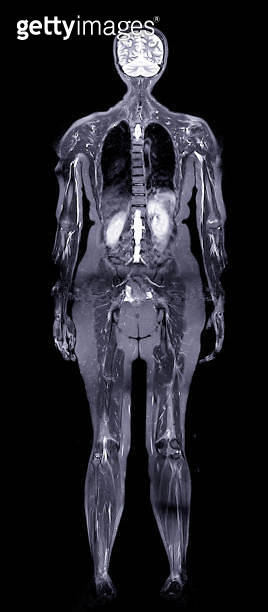 MRI whole body scans are beneficial for early cancer detection ...