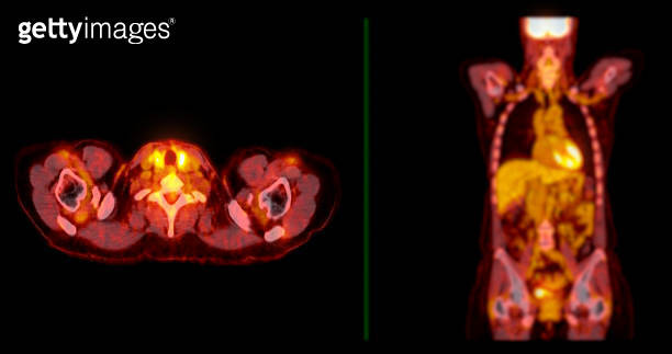 A PET-CT scan image is a diagnostic visualization combining Positron ...