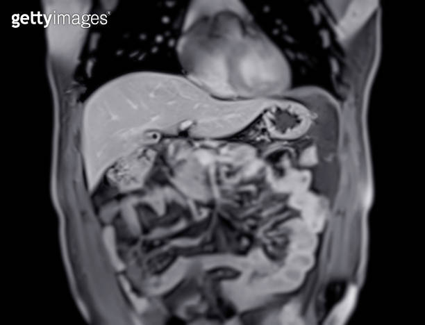 MRI abdomen coronal views are particularly useful for assessing liver ...