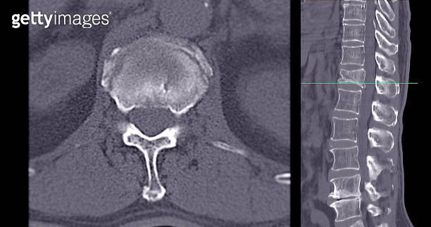 Spinal Compression Fracture at L1 Level - Lumbar CT Scan A detailed CT ...