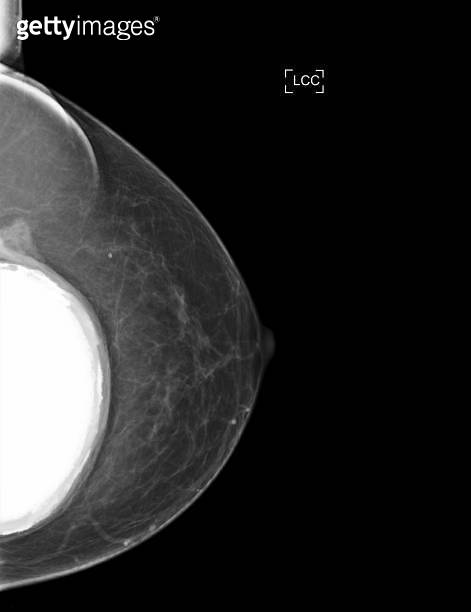 The mammogram BI-RADS 2-benign shows a breast implant augmentation with ...
