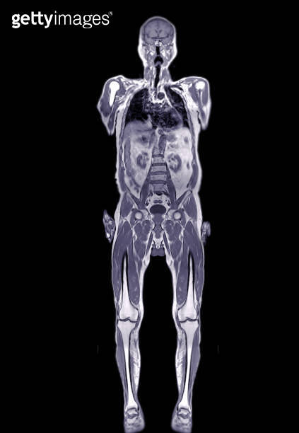 MRI whole body scans are beneficial for early cancer detection ...