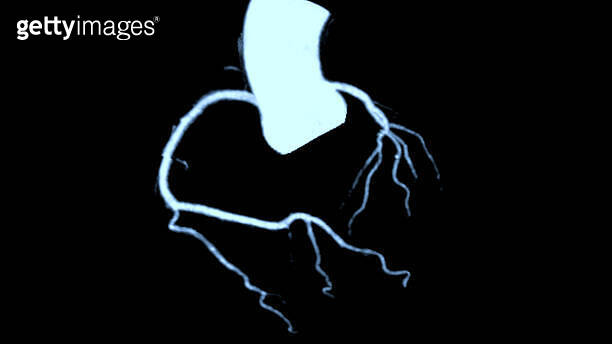 CTA coronary artery 3D rendering is a diagnostic imaging technique ...