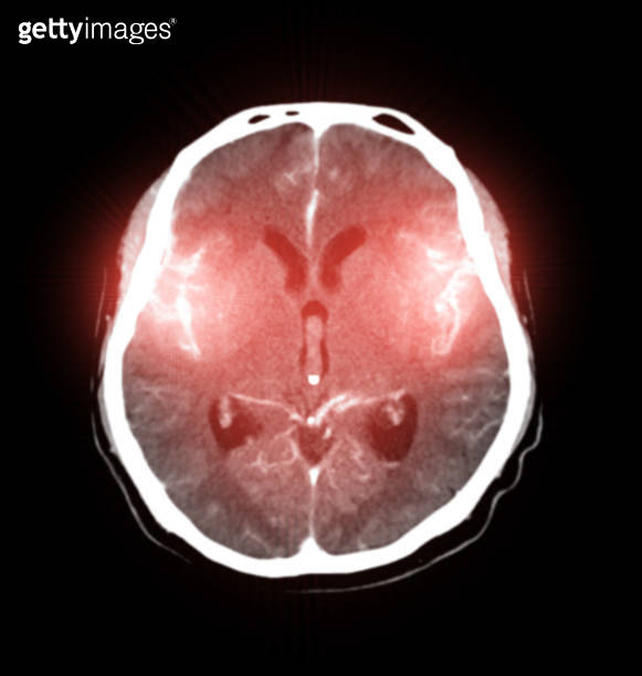 A CT brain scan reveals a subarachnoid hemorrhage with clear signs of ...