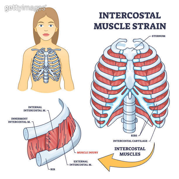 Intercostal muscle strain as muscular group in chest cavity outline ...