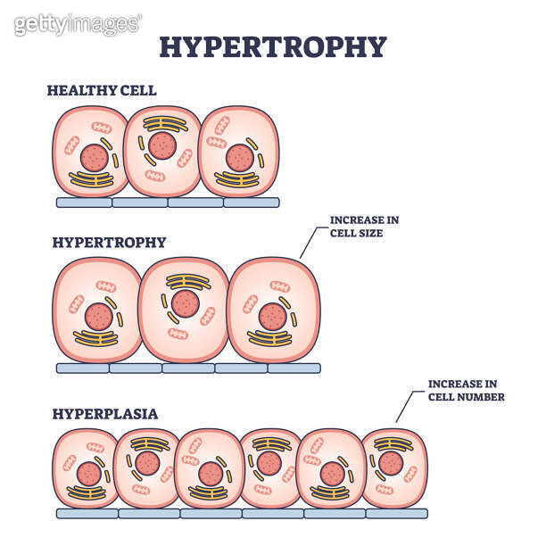 Hypertrophy, hyperplasia or healthy muscular cells comparison outline ...