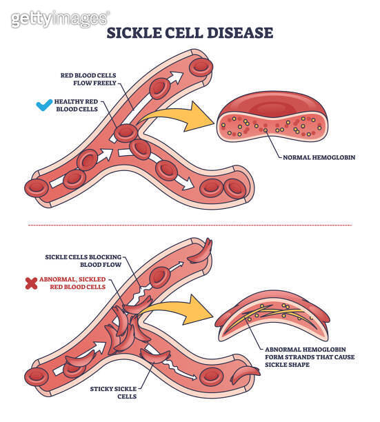 Sickle cell disease with abnormal red blood cell shape outline diagram ...