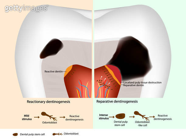 Tertiary dentin formation. Reparative dentinogenesis and Reactive ...