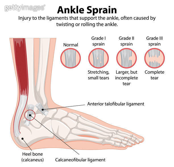 Detailed diagram of ankle sprain types (2154430787) 일러스트, 무료 일러스트 - 게티이미지뱅크