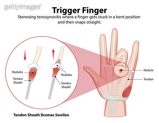 Diagram Explaining Trigger Finger Condition And Symptoms 이미지 2157385127 게티이미지뱅크
