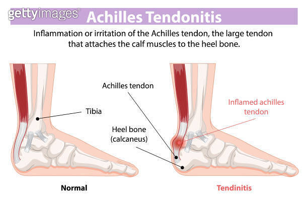Comparison of normal and inflamed Achilles tendon (2154412591) 일러스트, 무료 ...