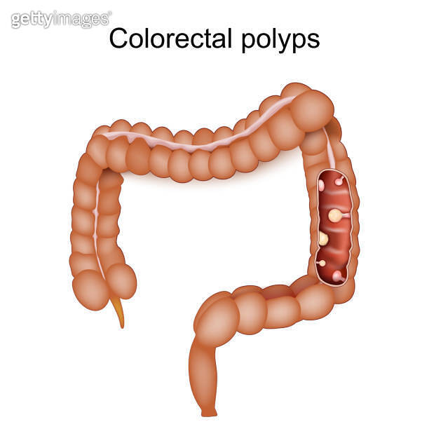 Colorectal polyps and Colon cancer. 이미지 (1952913584) - 게티이미지뱅크