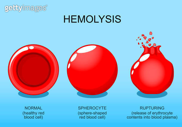 Hemolysis. Normal red blood cell, spherocyte, and rupturing of ...