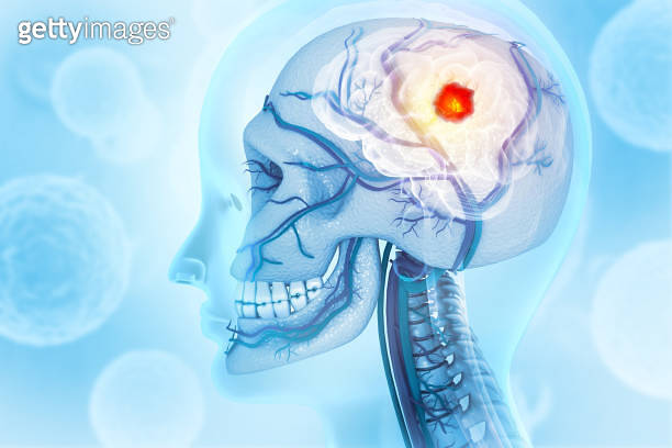 Visual concept of Bone cancer on the skull. 3d illustration 이미지 ...