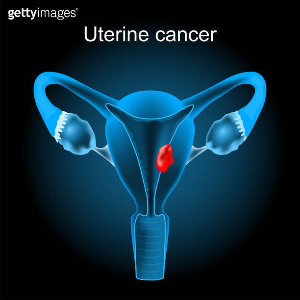 Uterine cancer. Cross section of a human uterus with Endometrial tumor ...