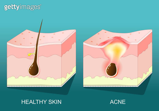 Acne. Cross section of a human skin with pimple (2010048621) 일러스트, 무료 ...