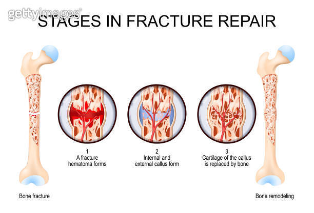 Stages in fracture repair. From Bone fracture to Bone remodeling ...