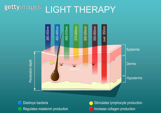 Light therapy. Phototherapy or laser therapy. 이미지 (1987500361) - 게티이미지뱅크