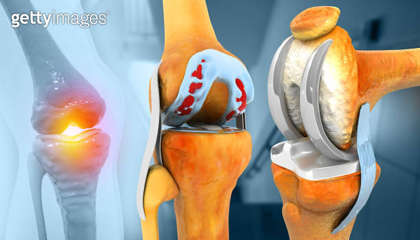 Knee Joint Replacement Surgery. 3d illustration 이미지 (1906999377) - 게티이미지뱅크