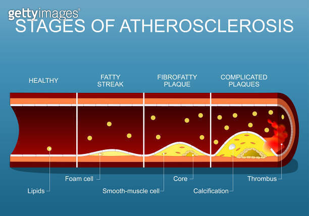 Stages of atherosclerosis. Close-up of an Arterial wall (2152323442 ...