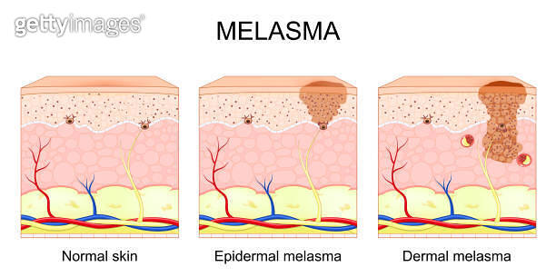 Melasma Types. chloasma faciei. Cross section of human skin with ...