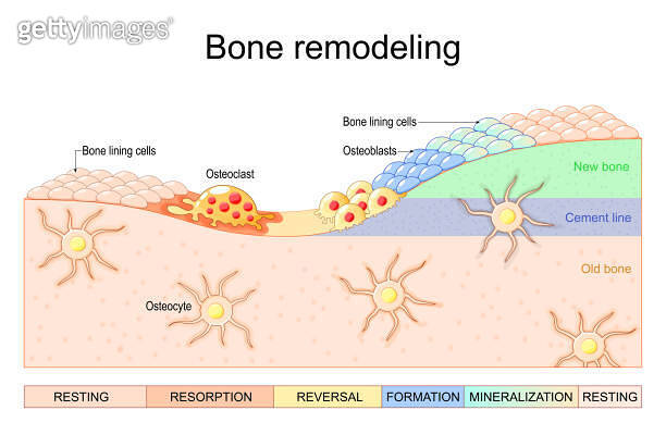 Bone remodeling process. Close-up of Osteoblasts, Osteoclast ...