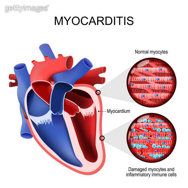 Myocarditis. inflammatory cardiomyopathy. Cross section of a human ...