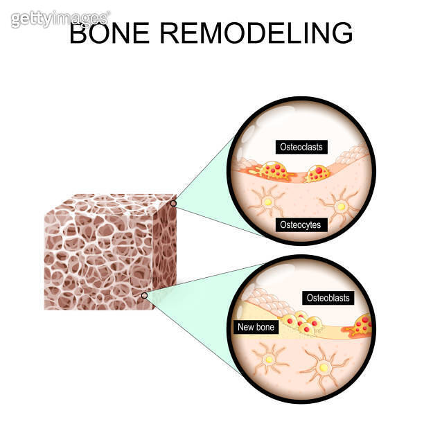 Bone remodeling from resorption to new bone formation 이미지 (2166288808 ...