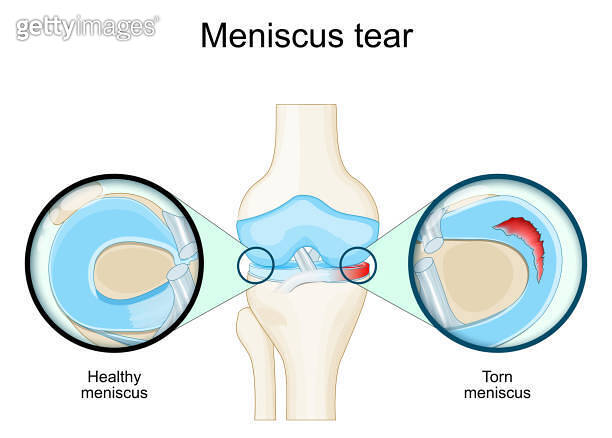 Meniscal tear. Knee anatomy. Close-up of Torn meniscus 이미지 (2164992673 ...