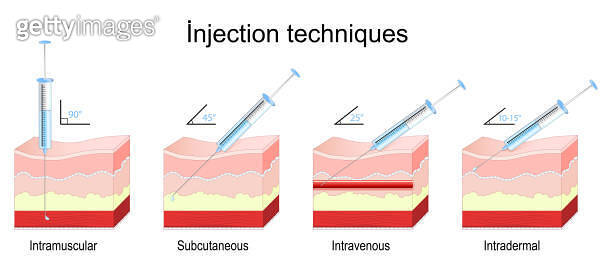 Injection methods. intramuscular, subcutaneous, intravenous, and ...