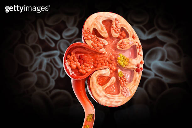 Nephrolithiasis kidney stones disease, medical concept. 3d illustration ...