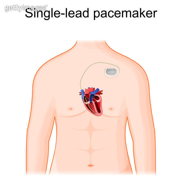 Single lead pacemaker placement. Cross section of heart and artificial ...
