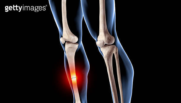 Medical Illustration of Broken Tibia on Male Skeleton 이미지 (2035506284 ...