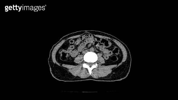 normal abdomen CT scan 이미지 (2160504586) - 게티이미지뱅크