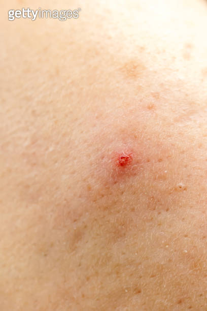 A close-up image of a small red bump on human skin, showcasing details ...