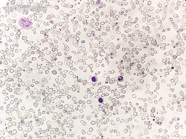 Abnormal red blood cells from Anemia patient 이미지 (2157138605) - 게티이미지뱅크