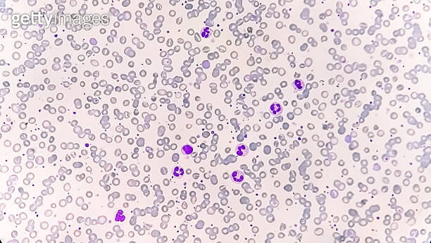 Anisocytosis anisochromia with both microcytic hypochromic and ...