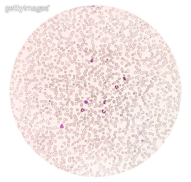 Anisocytosis anisochromia with both microcytic hypochromic and ...