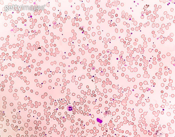 Anisocytosis anisochromia with both microcytic hypochromic and ...