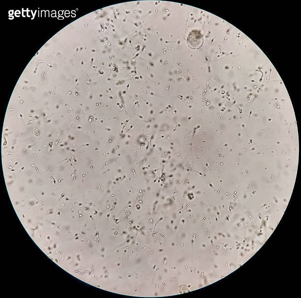 Asthenozoospermia (AS, a common cause of human male infertility ...