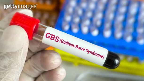 Guillain-Barre syndrome (GBS) test, a rare disorder where the body's ...